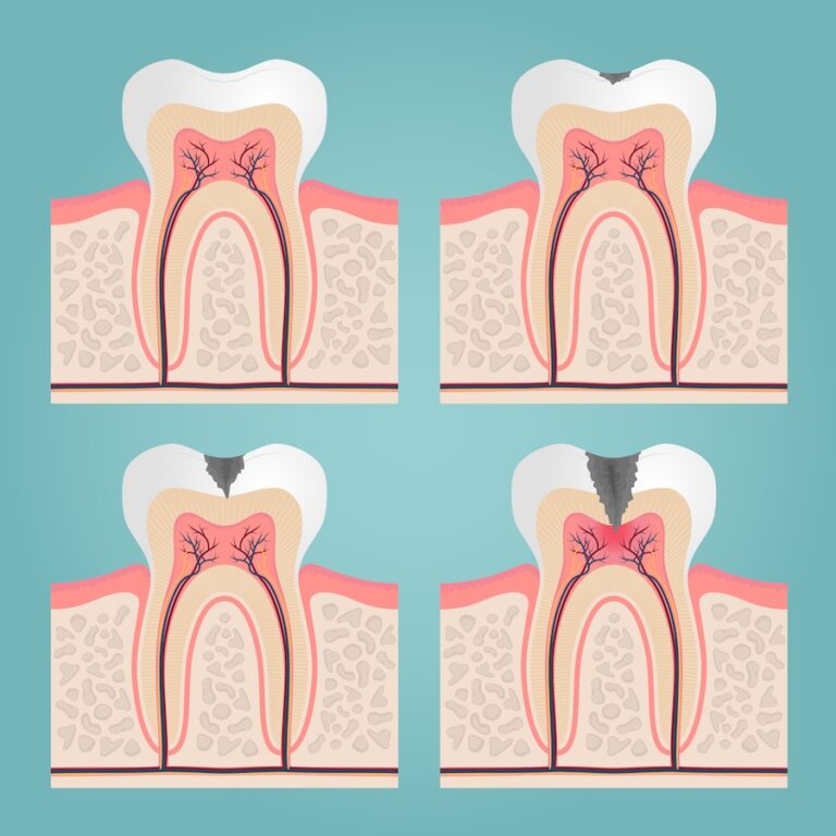 Early Signs of Tooth Decay You Shouldn't Ignore | Queensboro Plaza ...