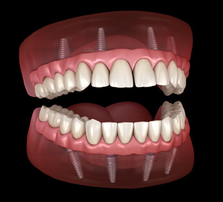 Maxillary and Mandibular prosthesis with gum All on 4 system supported ...