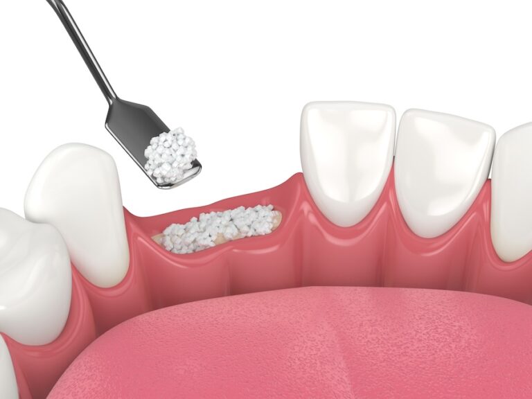 3D render of dental bone grafting with dental bone biomaterial ...
